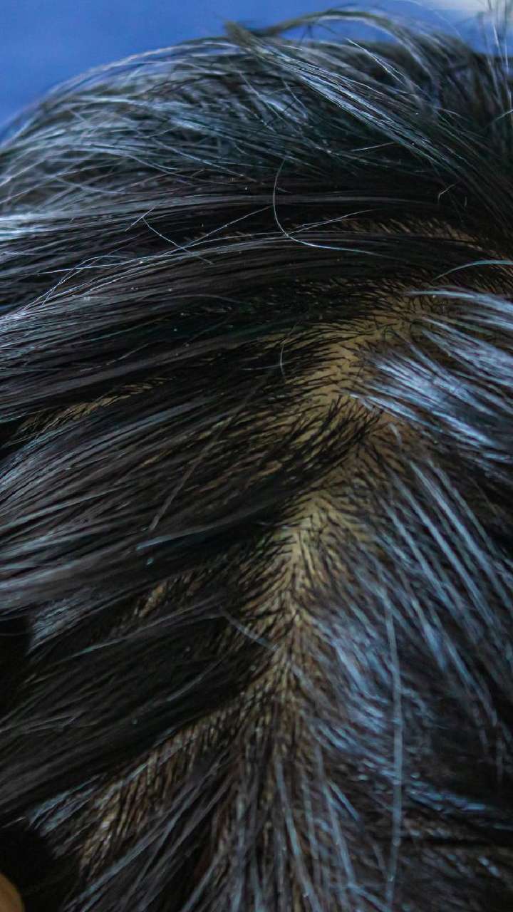 How To Find Out Your Scalp Type?