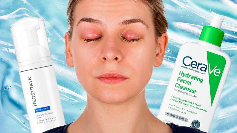 Eyelid Breakouts: How To Treat & Prevent Them