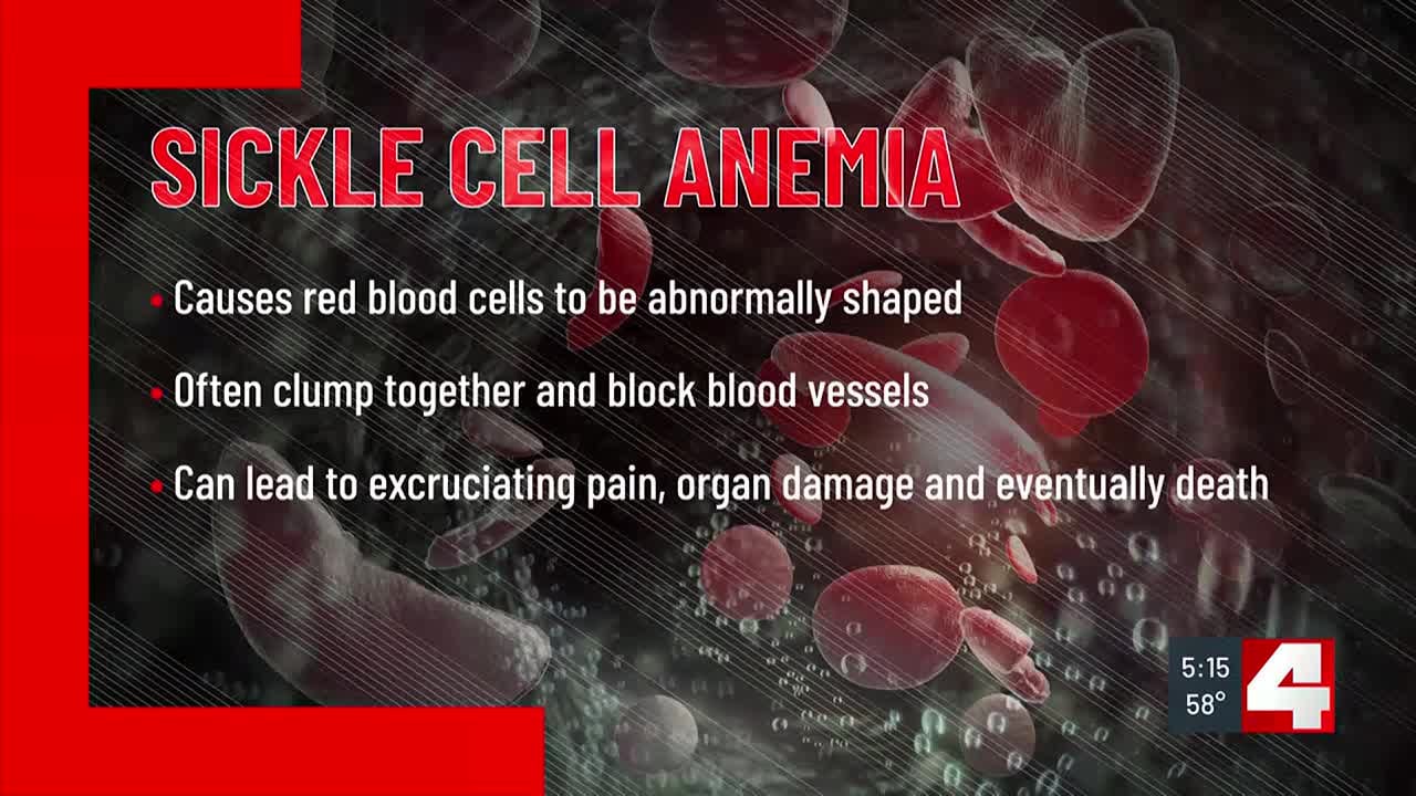 New gene therapy considered cure for Sickle Cell Disease being ...