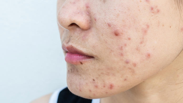 The real story behind teenage pimples and how it can change future acne ...