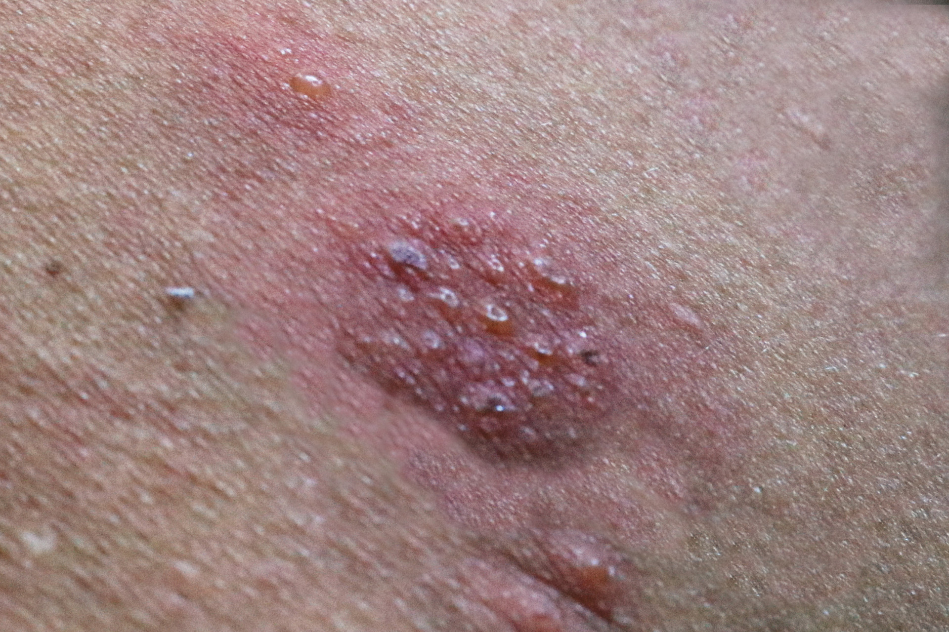 99% of Americans have the shingles virus right now