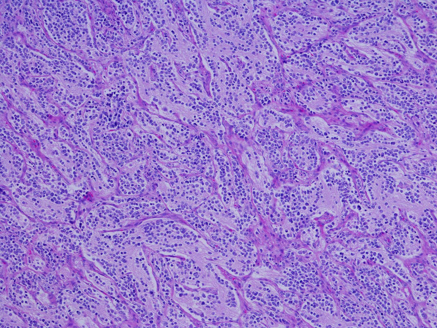 Y-mAbs gets NCCN recommendation for neuroblastoma treatment