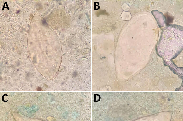 Hybrid schistosome parasites lead to calls for new diagnostic methods