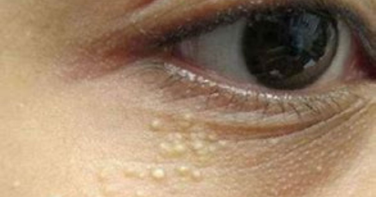 Micro boutons blancs : comment se débarrasser des grains de milium