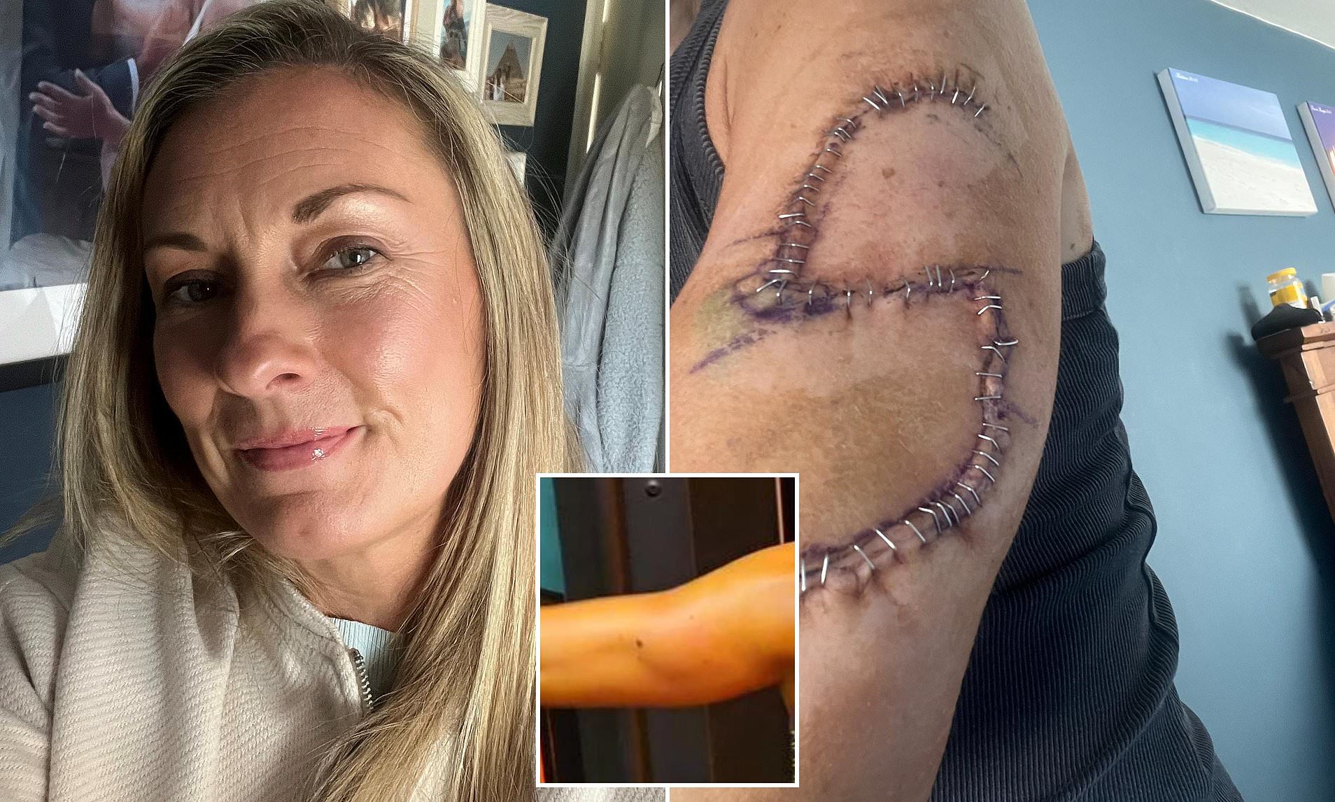 The 'normal' mole on mother's arm that turned out to be skin cancer ...