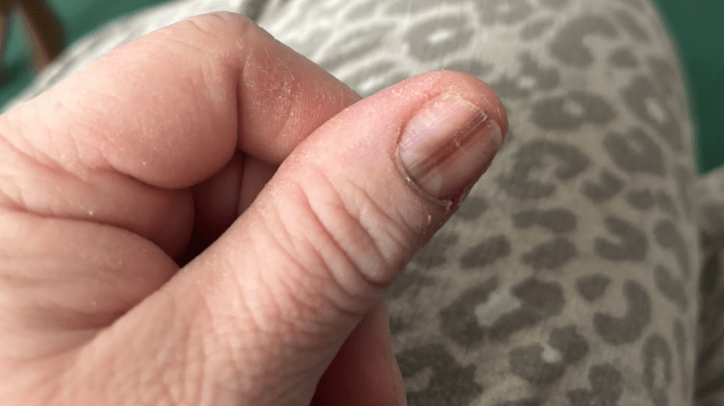 If you see this line on your fingernail, see your doctor immediately ...