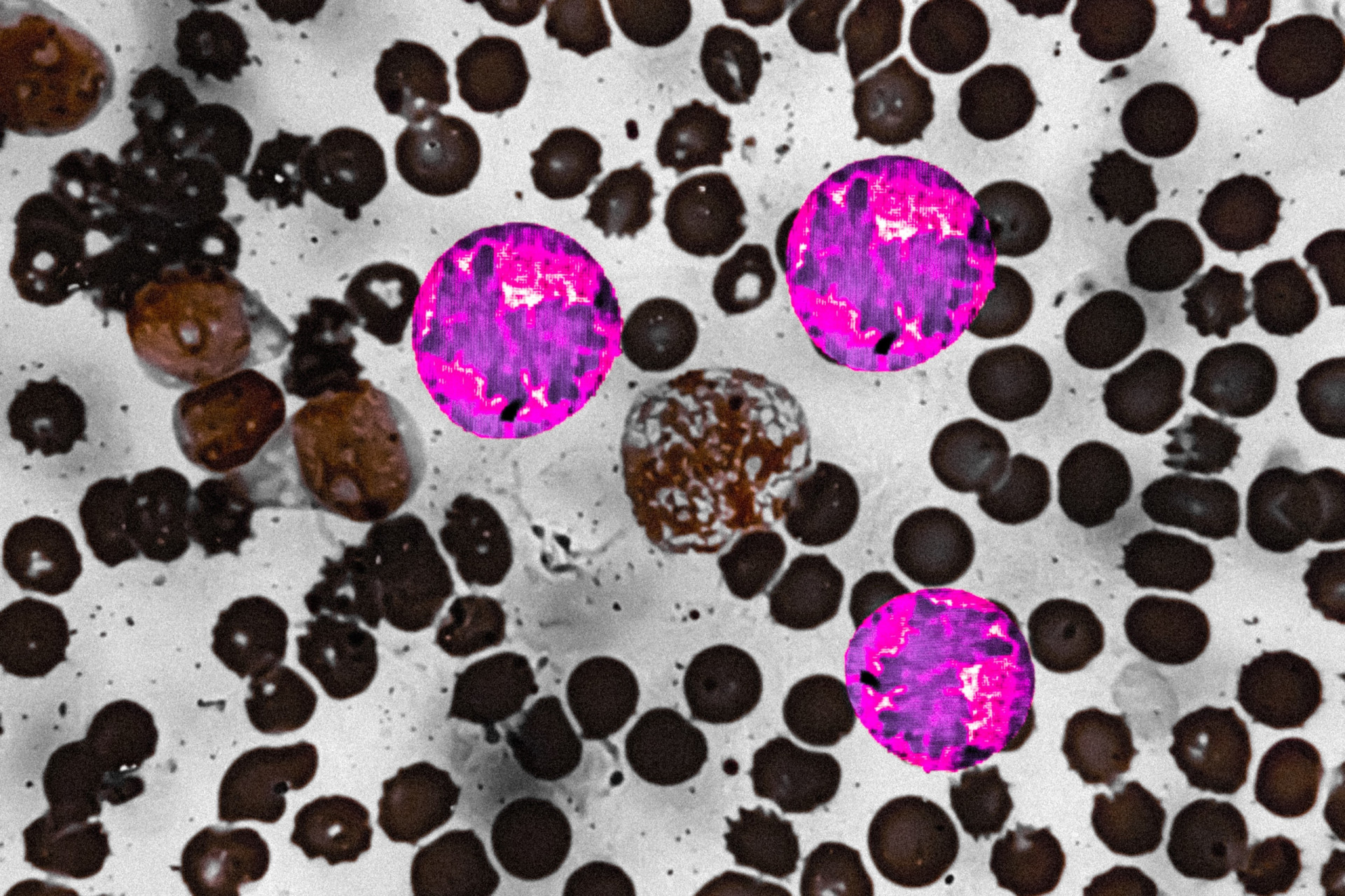 What to know about stage 0 cancer