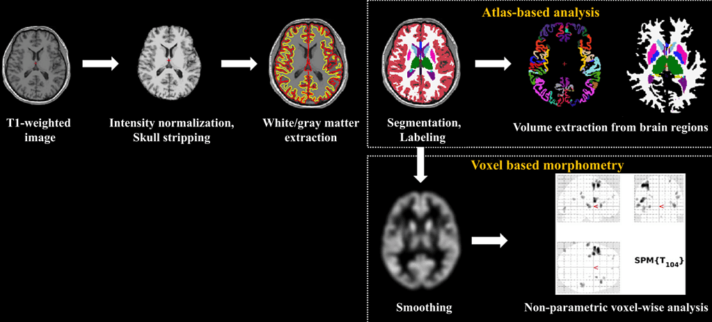 Working overtime may be reshaping your brain