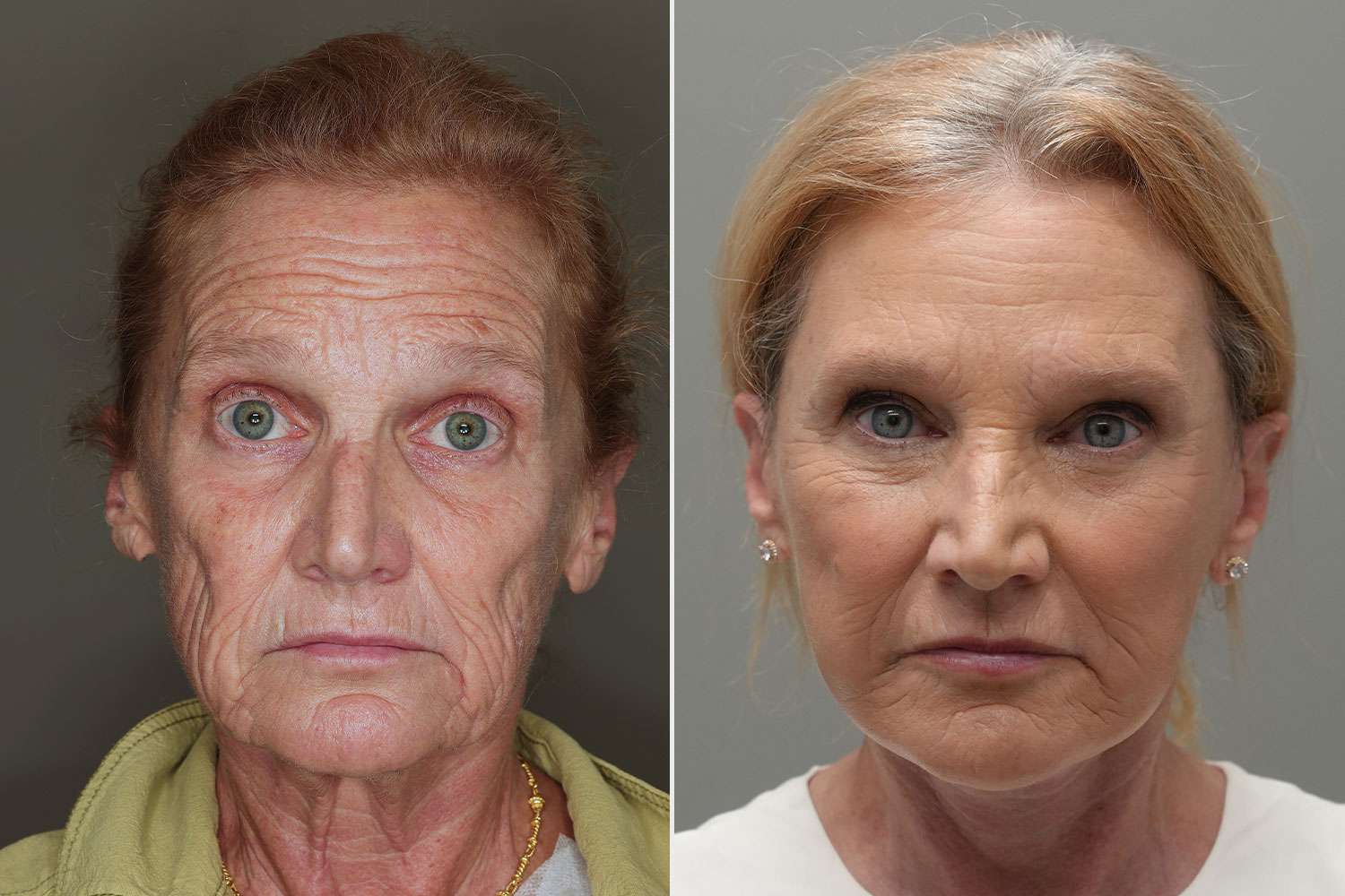 Woman, 67, 'Couldn't Close' Her Eye After Botched Facelift. One 4-Hour ...