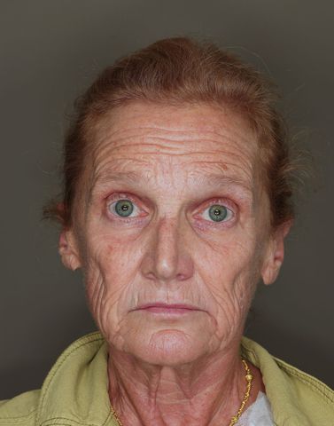Woman, 67, 'Couldn't Close' Her Eye After Botched Facelift. One 4-Hour ...