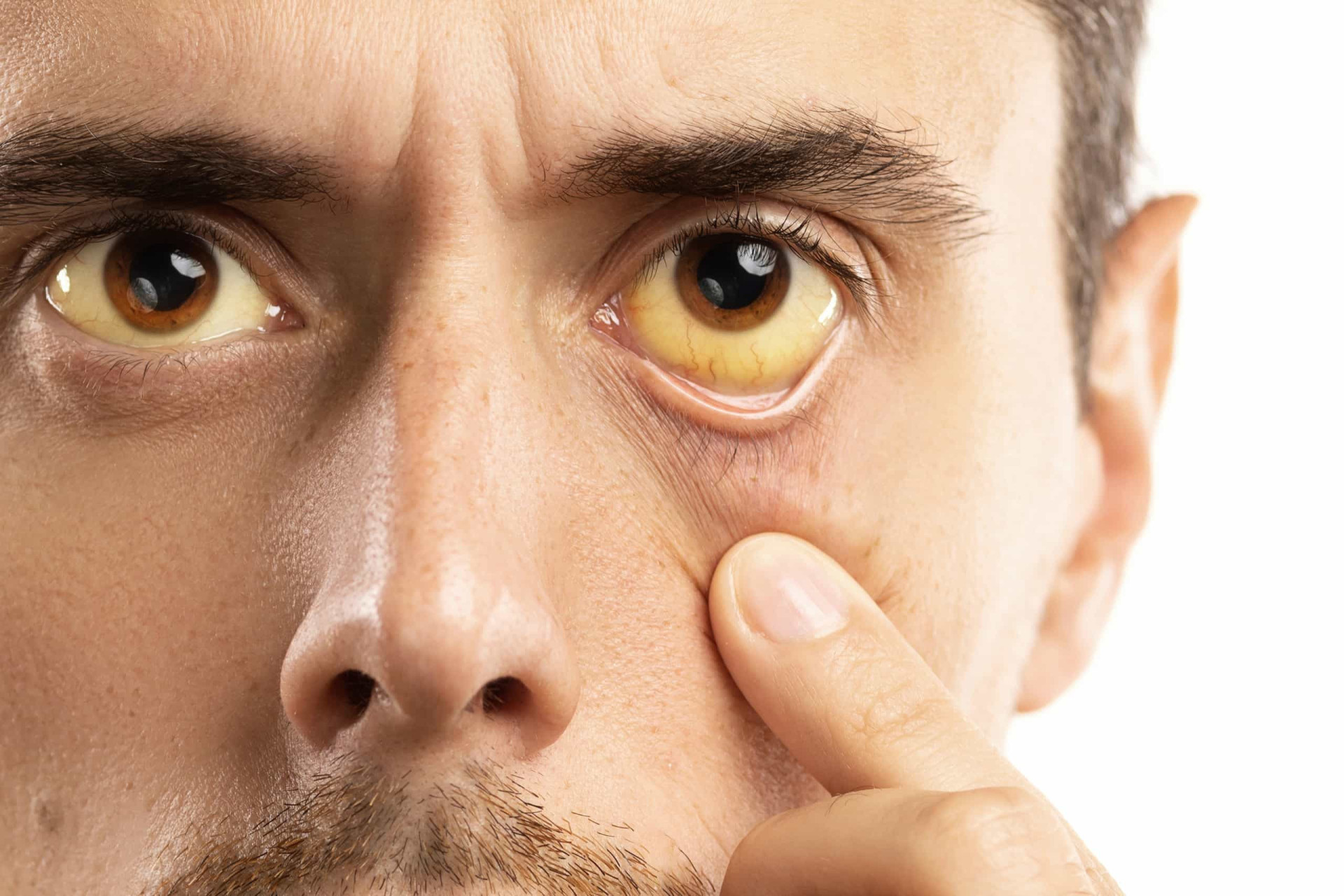 What are the early symptoms of hepatitis?