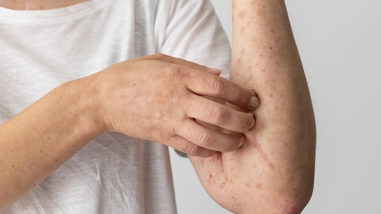 Having skin blisters in summer? It can be photodermatitis; dermat ...