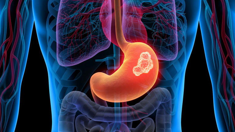 Ben Rathbun, '90 Day Fiance' Succumbs to Stage 4 Stomach Cancer at 55 ...