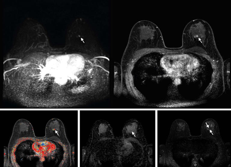 Shorter MRI exam effectively detects cancer in dense breasts