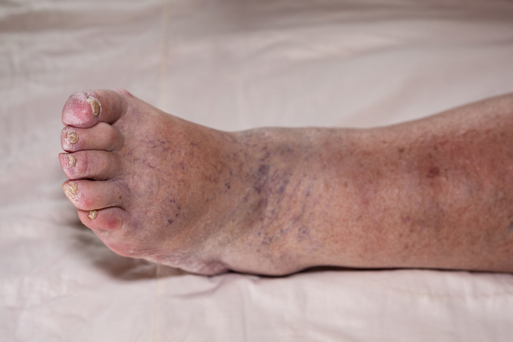 This Old Sock Hack Will Make Swollen Legs Disappear Overnight