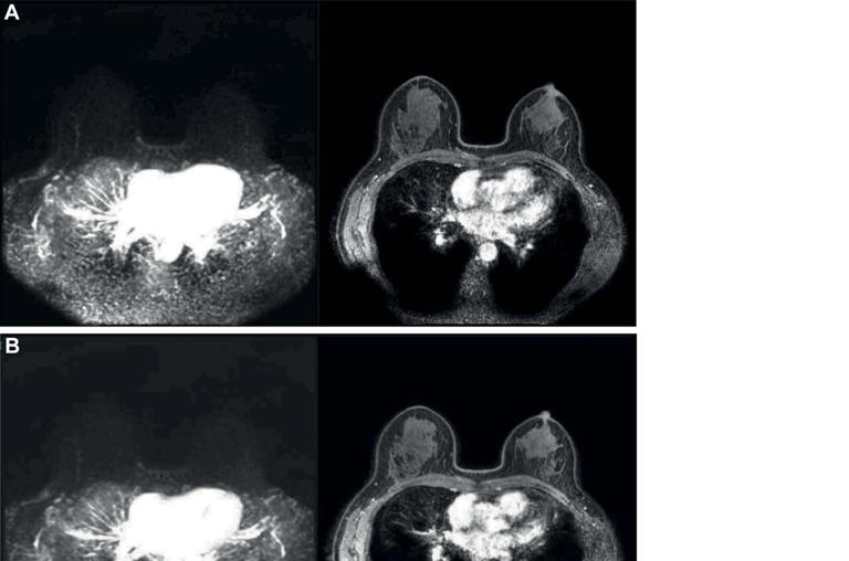 Shorter MRI exam effectively detects cancer in dense breasts