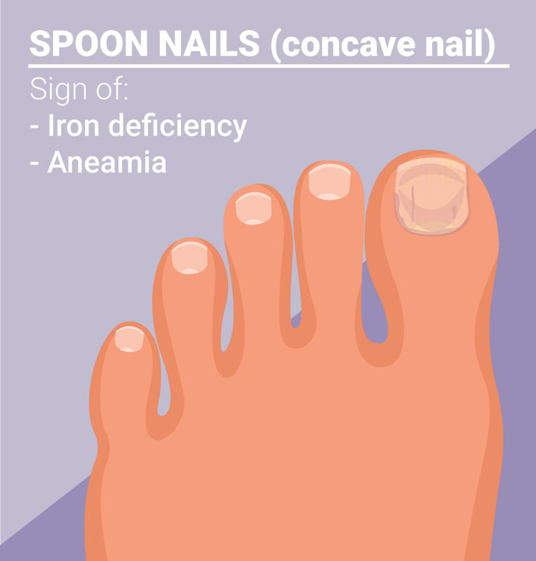 What your toes say about your health — 8 warning signs to look out for