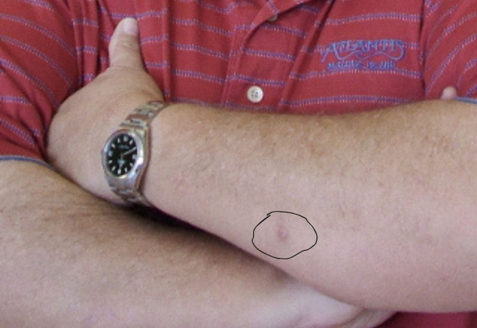 8 Rarest Cancers in World