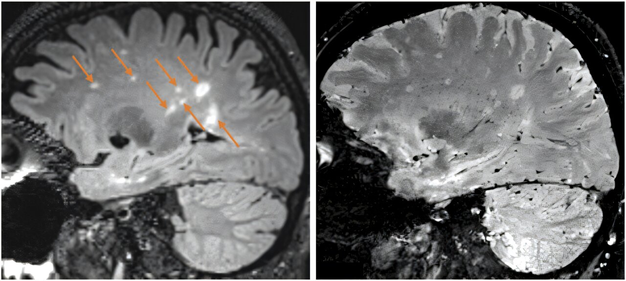 MRI could replace painful spinal tap to diagnose multiple sclerosis ...