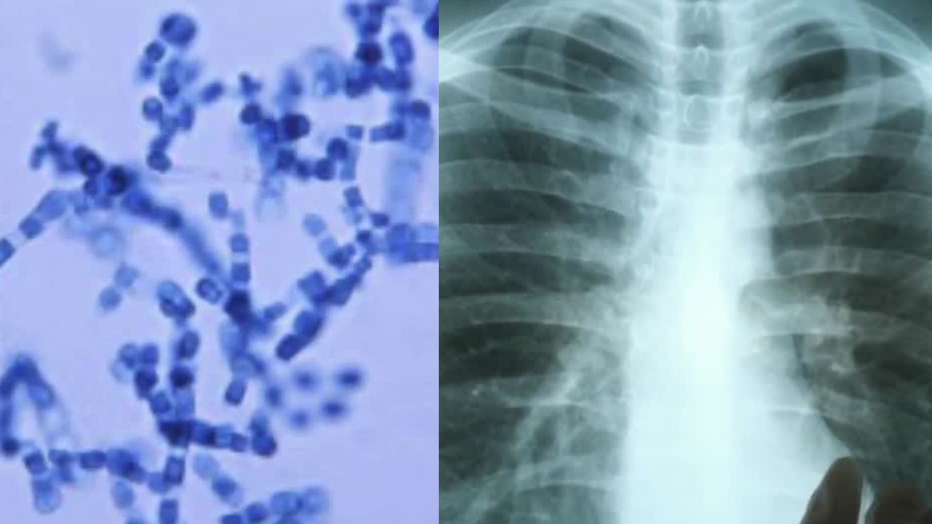 Hidden fungus causing more Valley Fever in southern Utah