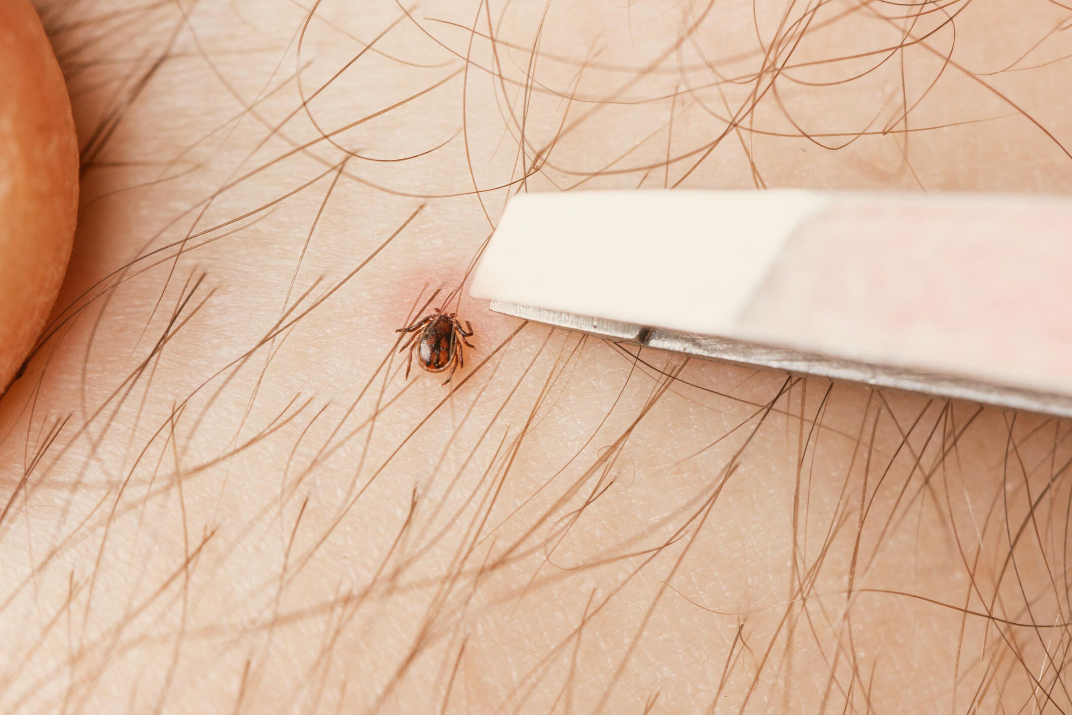 This Tweezer-Free Removal Hack Saved Me During Tick Season