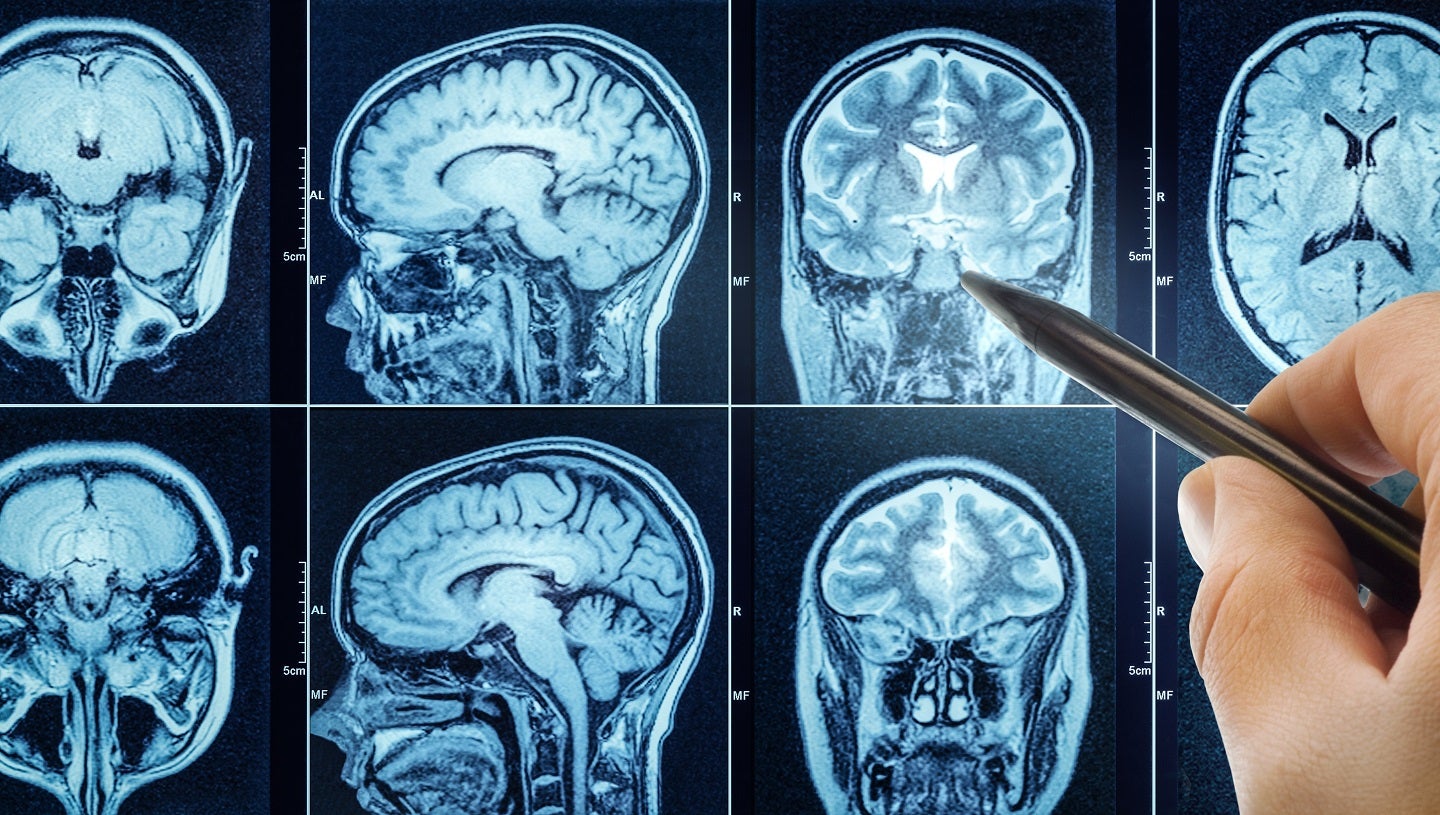 Imvax to explore FDA pathway for glioblastoma candidate despite PFS miss
