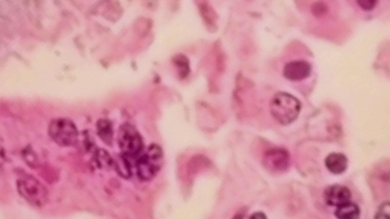 Measles in Central Texas: 6 cases detected in Williamson County