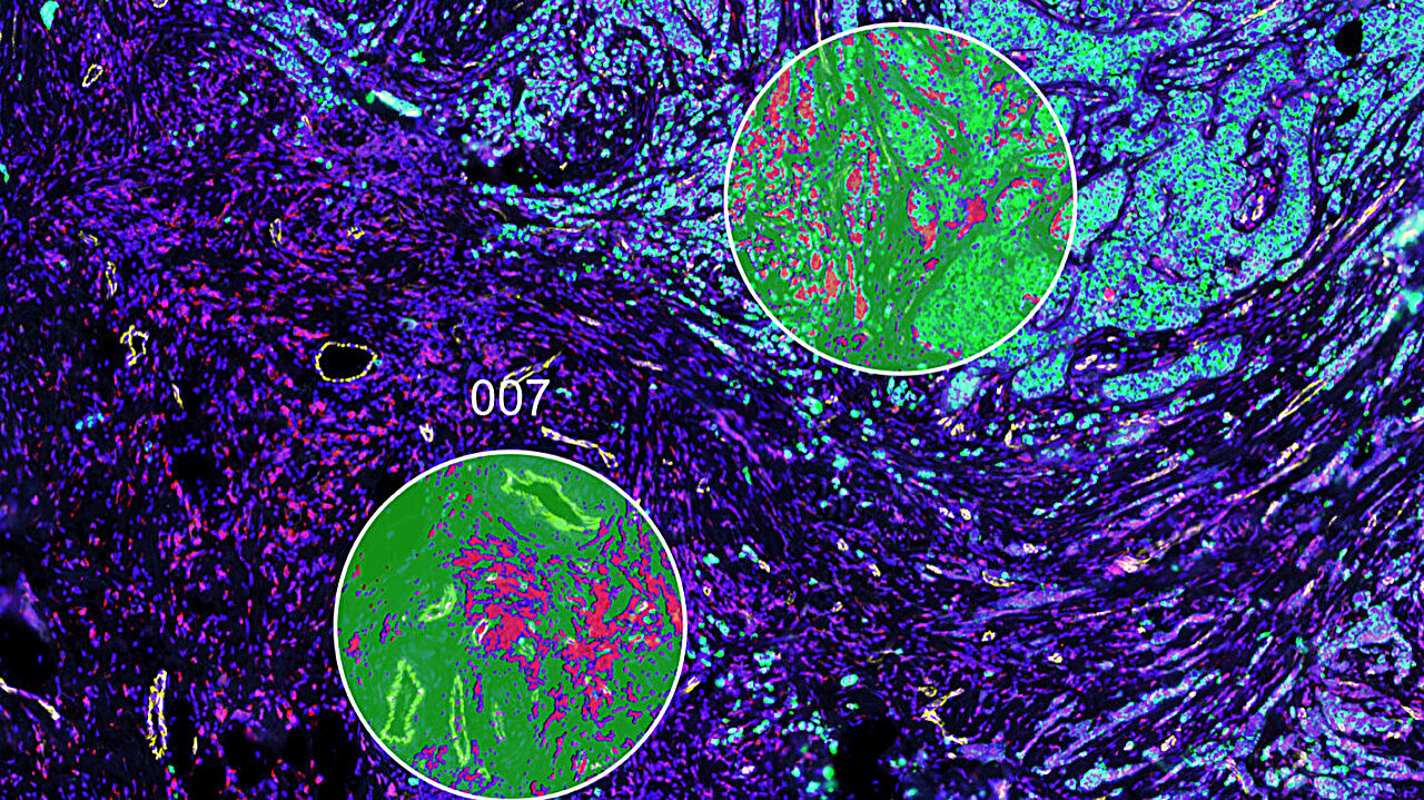 Study advances cancer precision therapies by identifying patients who benefit from bexmarilimab ...