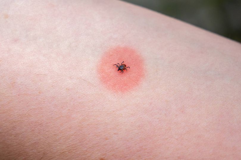 NHS list of 14 different insect bites, their symptoms and how to treat them