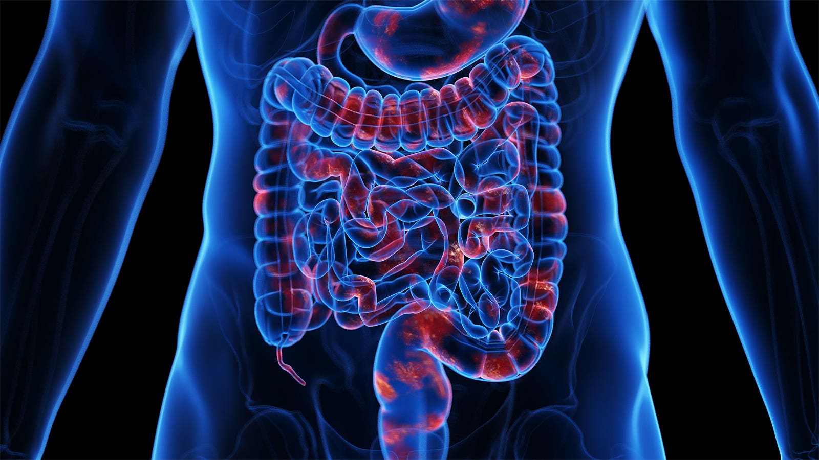 Is It Crohn's or Ulcerative Colitis? IBD Types Are Similar but Not the Same