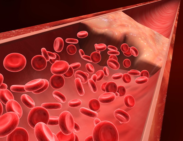 Extended use of anti-clotting drugs reduces risk of recurrent blood clots