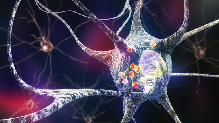 Autism Tied to Early-Onset Parkinson's Disease