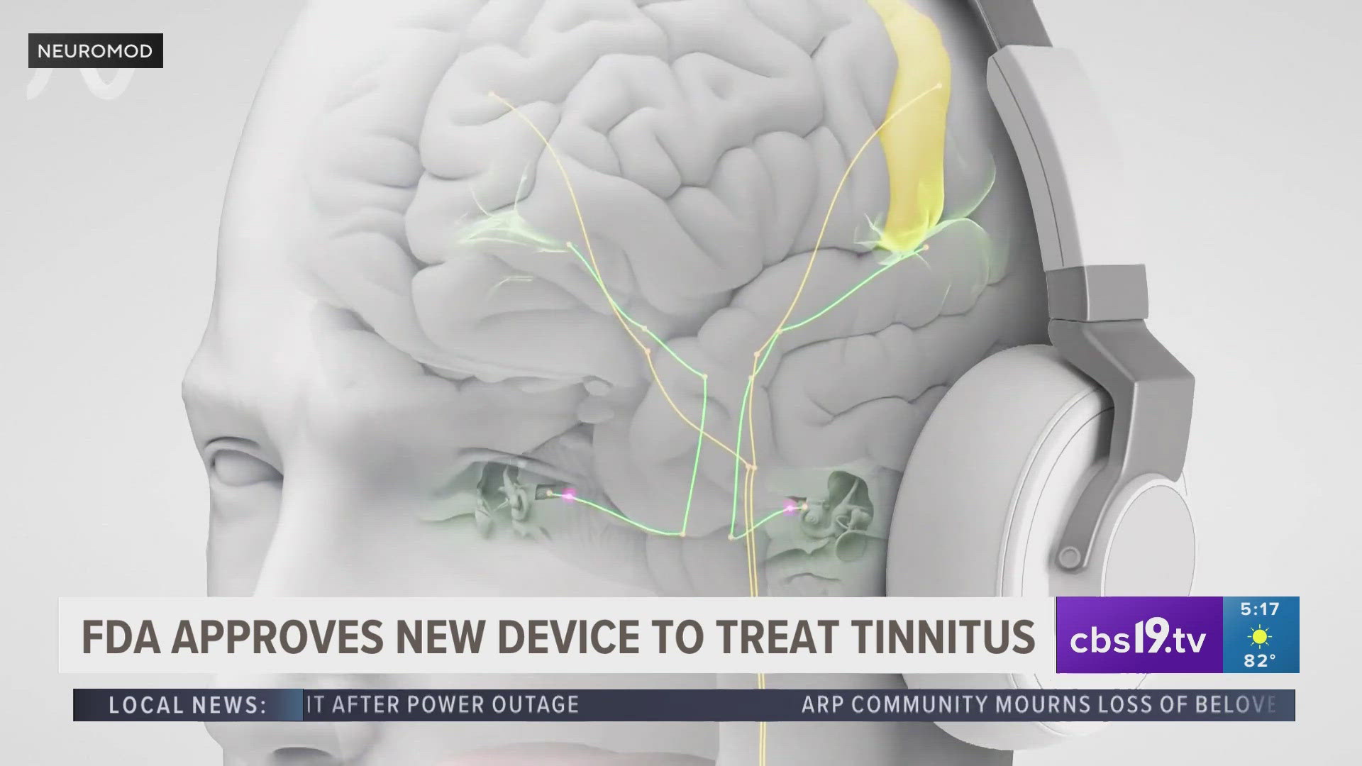 FDA approves new device to treat tinnitus