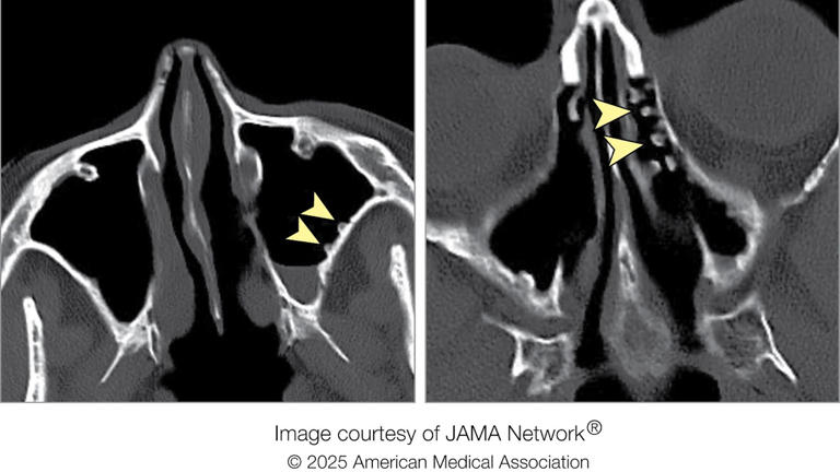 Diagnostic dilemma: Cold-water rinses left 'cobblestone' growths in ...