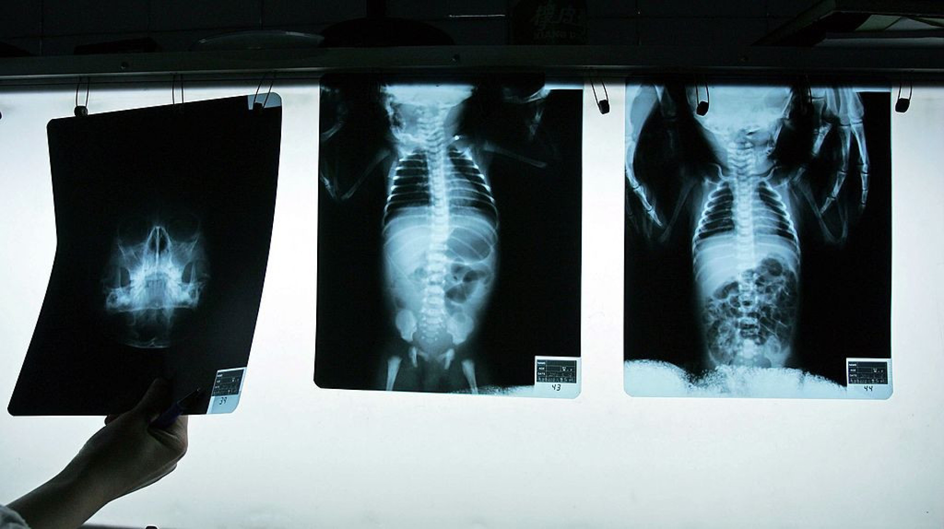 What exactly is fragile X syndrome?