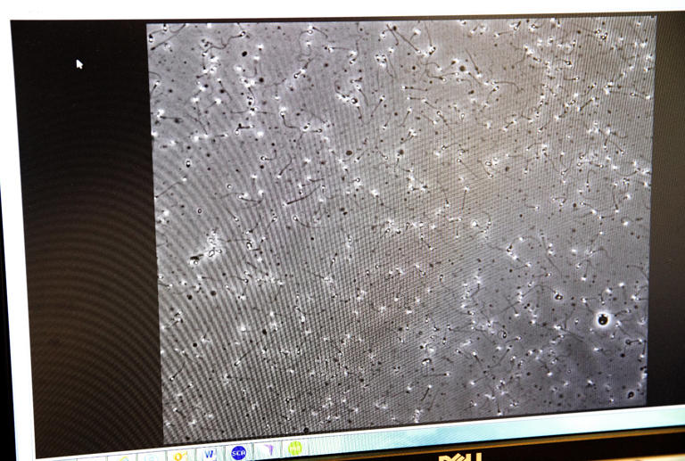 Dansk sæddonor hadde sjelden genmutasjon – ti av hans 67 barn har fått kreft