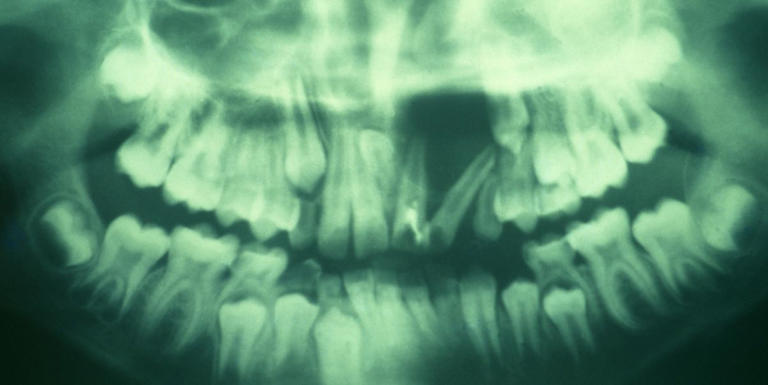 Have Sensitive Teeth? Scientists Say They May Have Evolved to Feel—Not Chew