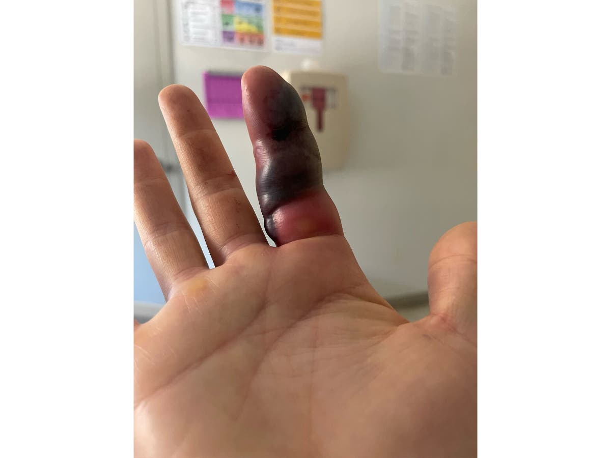 Copperhead Snake Bite In Palisades Sends Man To NJ Hospital