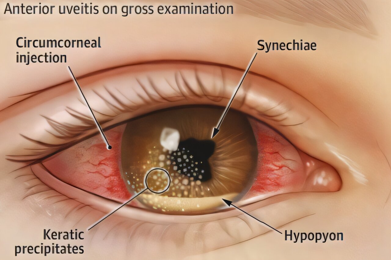 Early detection is key to improving treatment of uveitis, a global ...
