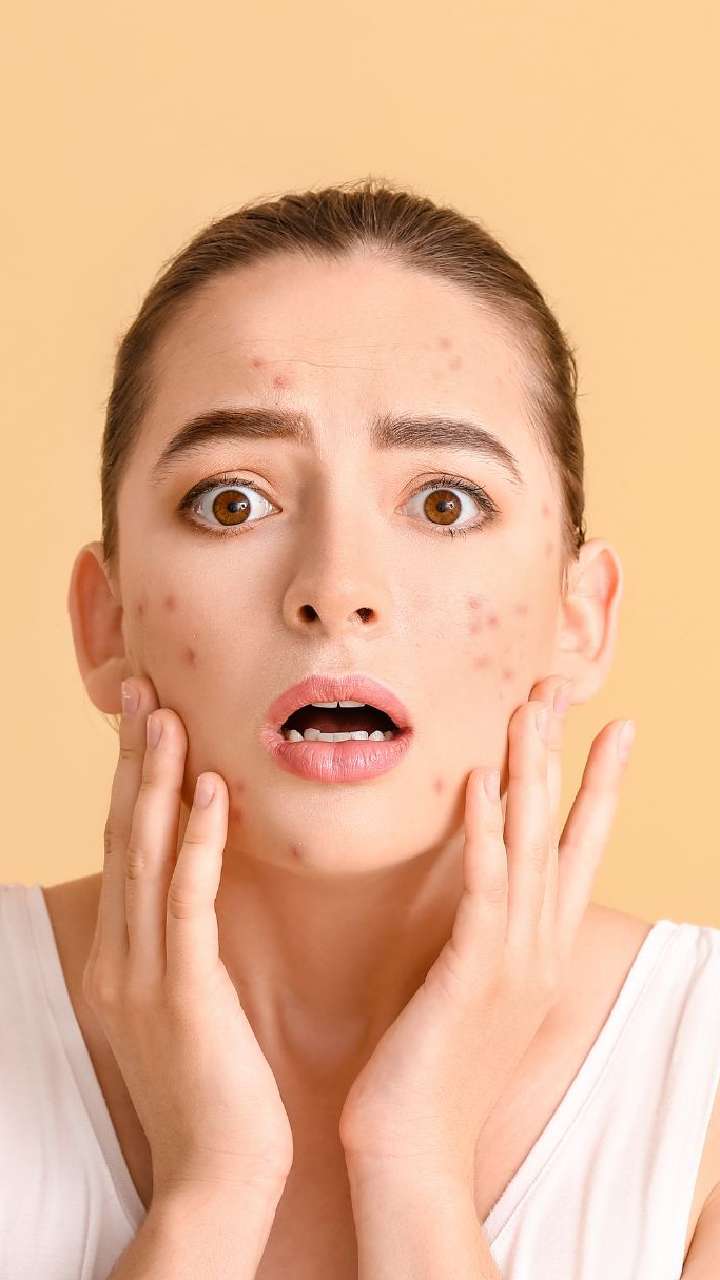Can Dairy Product Consumption Cause Acne? Check Facts!
