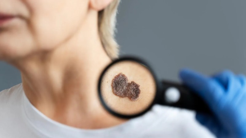 Understanding mole mapping: A key to early skin cancer detection