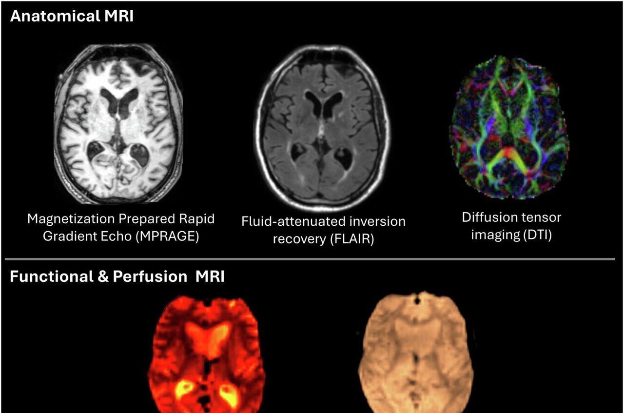 Decade-long brain aging study releases open-access data for global ...