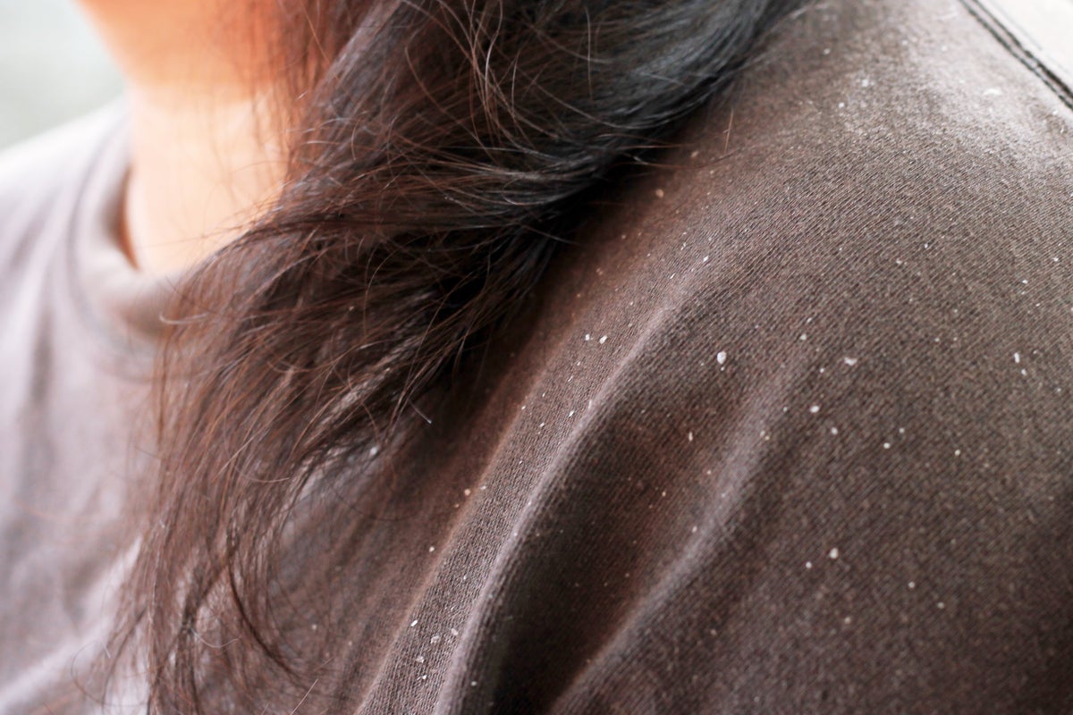 There are many causes of dandruff – but how do you prevent it?