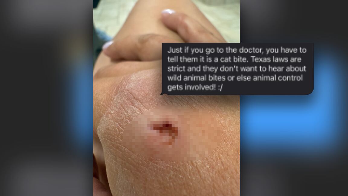 College Station woman undergoes rabies treatment after lemur bite at ...