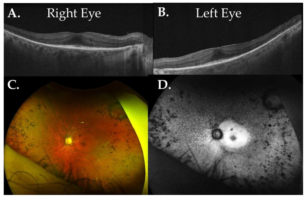 Unlocking the genetics of blindness: New hope for sufferers of ...