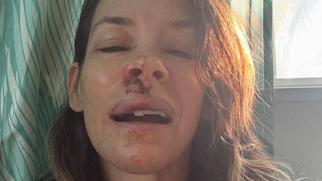 Evangeline Lilly suffers facial injuries after fainting at the beach
