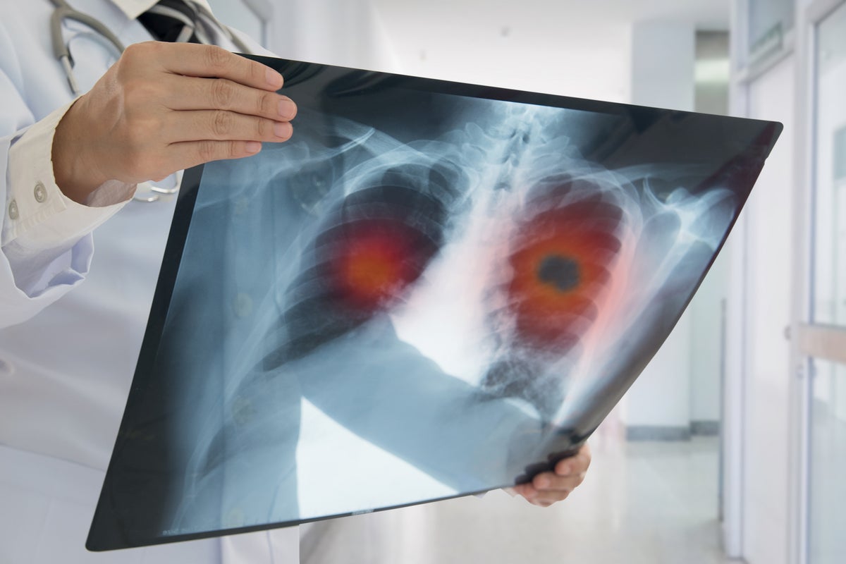 Nine small health issues that could be an early sign of lung cancer
