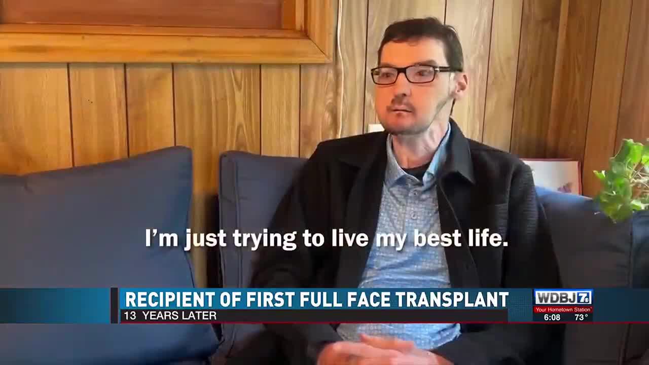 Face transplant recipient updates WDBJ7 13 years later