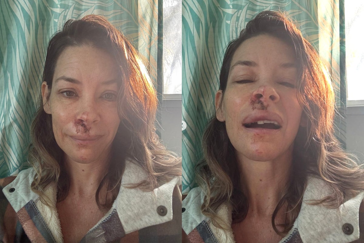 Evangeline Lilly shows off bloody facial injuries after fainting and ...