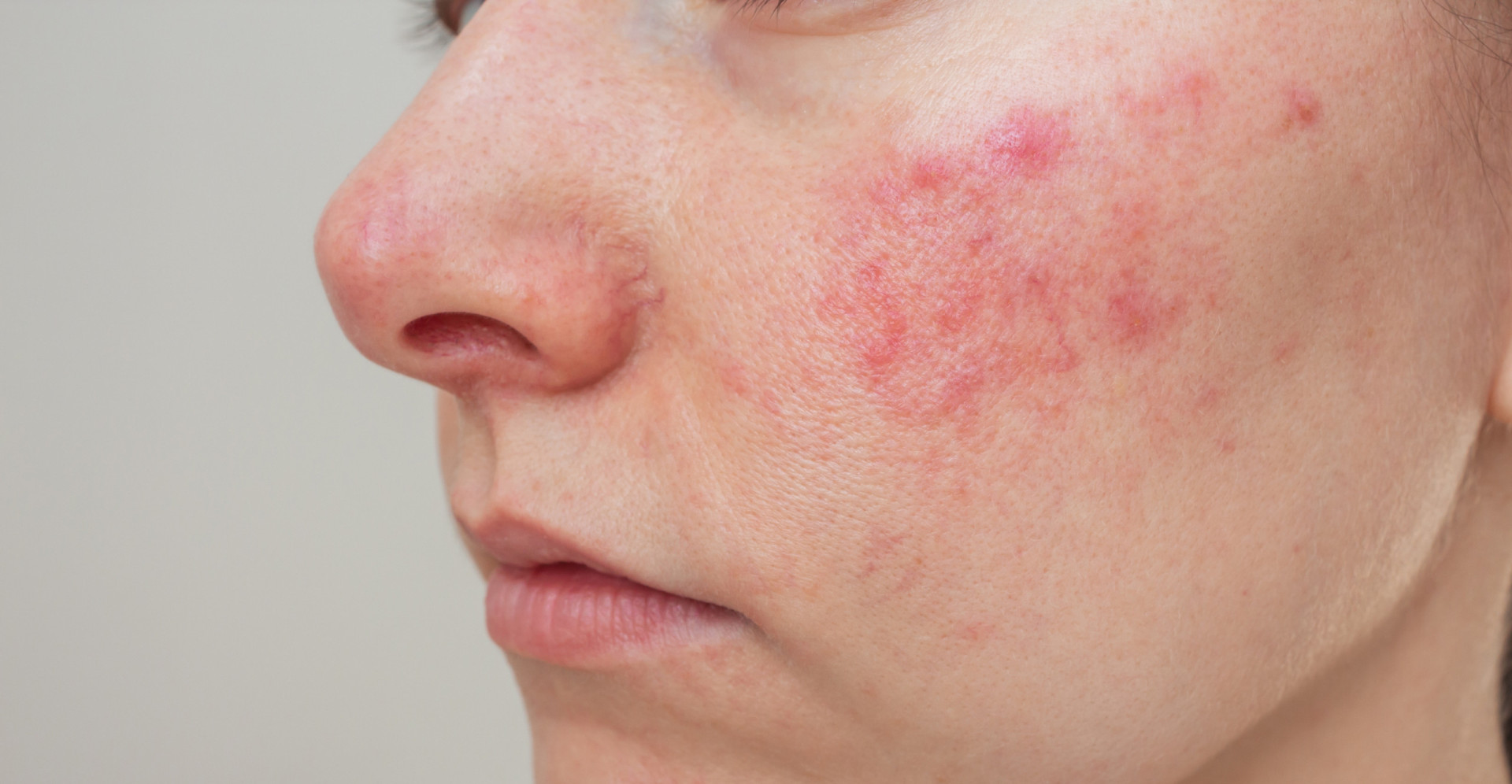 Facing up to the skin condition called rosacea